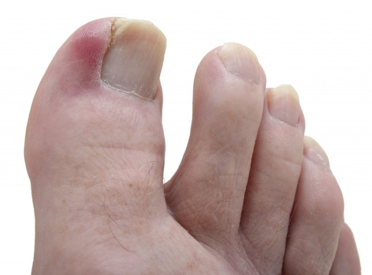 Why Is Matrixectomy Used For Treating Ingrown Toenails? - Targetey